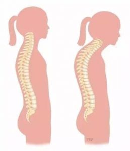 5 Poor Postures You Can Correct Right Now | Pro Fusion Rehab